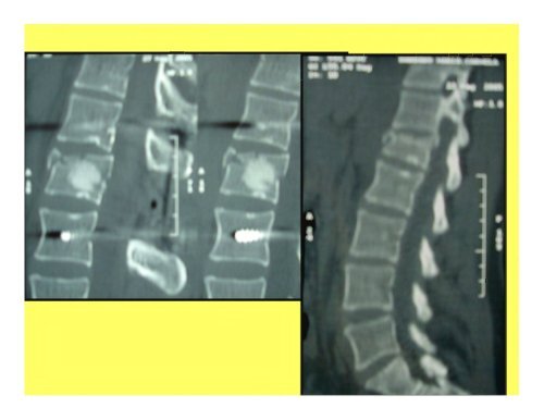 OptiMesh con osso omologo : indicazione, tecnica ... - Spineology