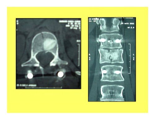 OptiMesh con osso omologo : indicazione, tecnica ... - Spineology