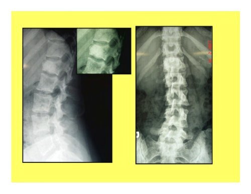 OptiMesh con osso omologo : indicazione, tecnica ... - Spineology