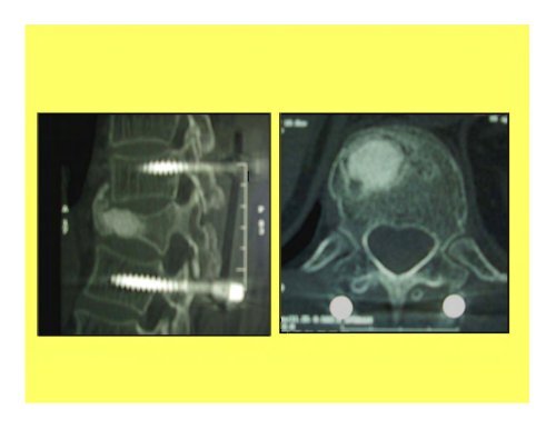 OptiMesh con osso omologo : indicazione, tecnica ... - Spineology
