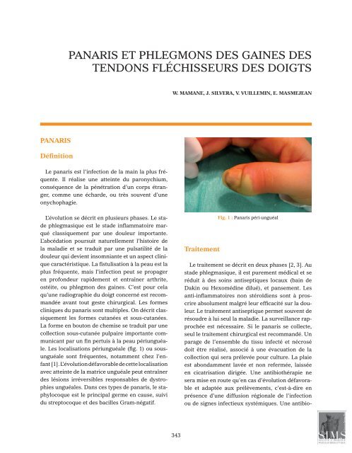 Panaris et Phlegmons des gaines - Chirurgie de la main