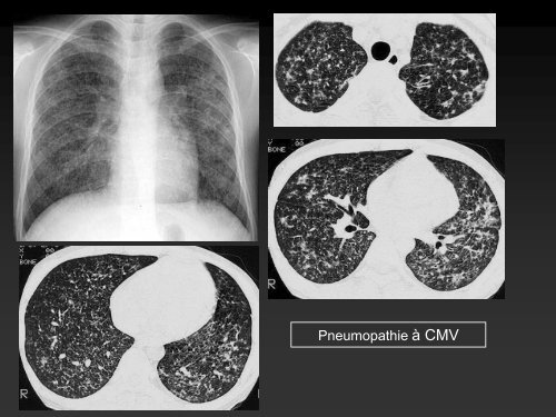 Pneumopathie à CMV