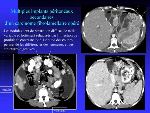 Multiples implants périt