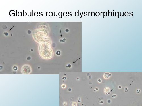 Globules rouges dysmorphi