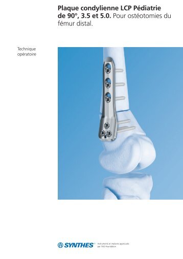3.5 mm LCP Medial Proximal Tibia Plates Technique Guide - Synthes