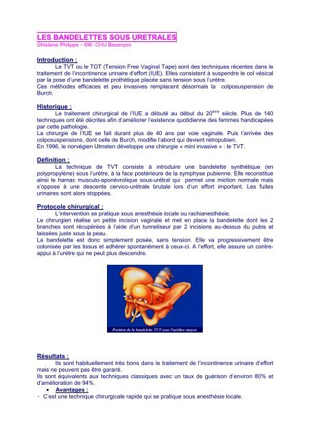 Les bandelettes TVT et TOT - geyre electronique