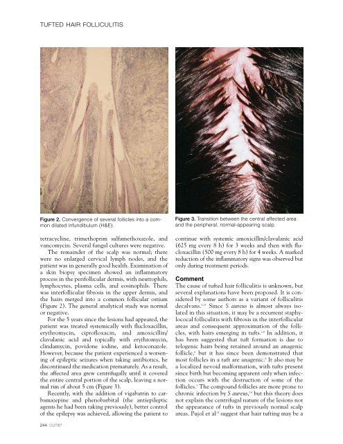 TUFTED HAIR FOLLICULITIS