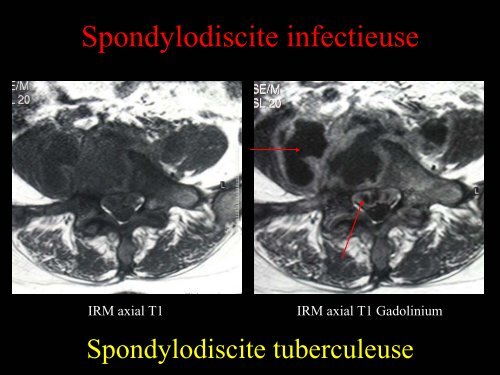 Spondylodiscite infectieu