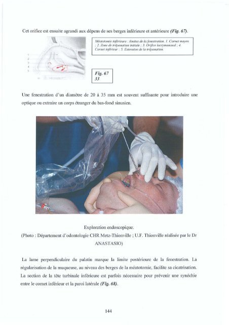Méatotomie inférieure
