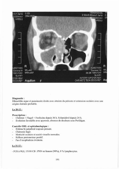 Diagnostic: Ethmoïdite a