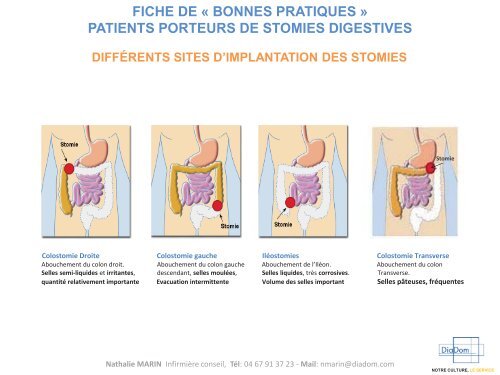 Fiche conseil stomie digestive
