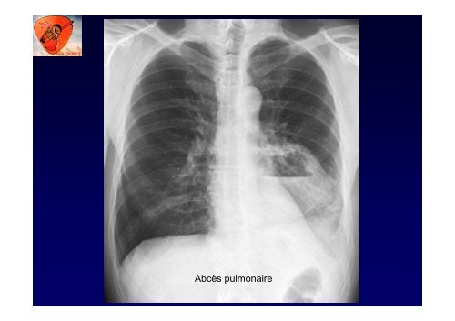 Abcès pulmonaire