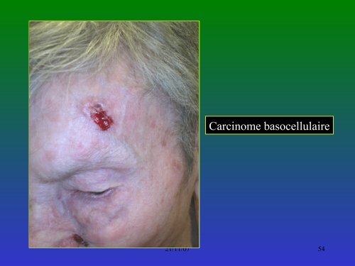 Carcinome basocellulaire