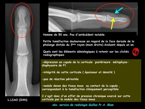 LM CC ostéo-artic tumeur glomique des doigts - RADIOLOGIE ...