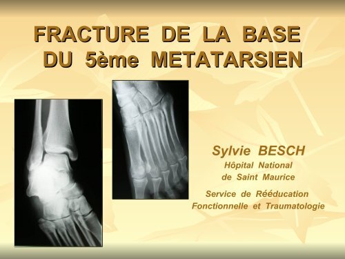 Fractures de la base du 5ème métatarsien