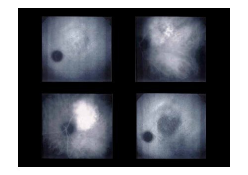 Retinal imaging. From Helmholtz's ophthalmoscope to adaptive optics.