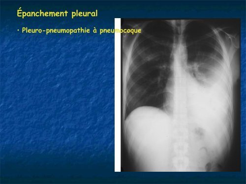 Pleurésie purulente Com