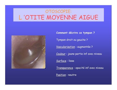 OTOSCOPIE: L ’OTITE MOY