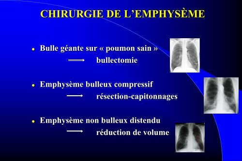 Comment Se Produit L’Emphysème – MGNAR
