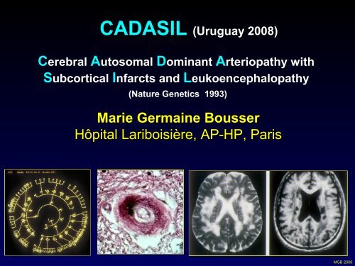 The story of CADASIL