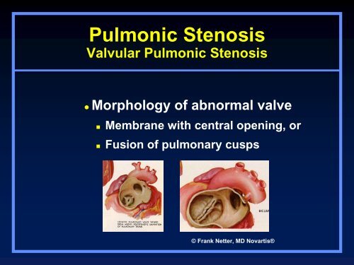 Pulmonic Stenosis