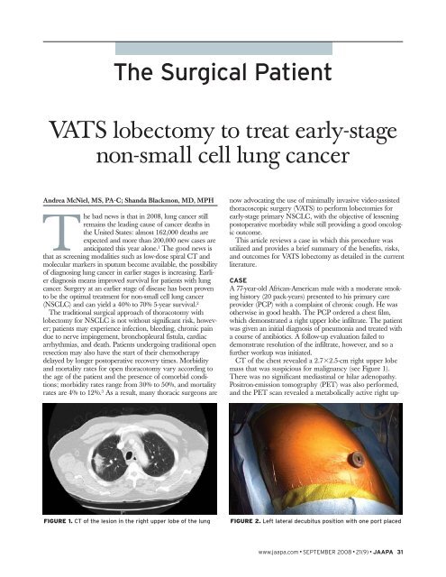 Vats Lung Cancer