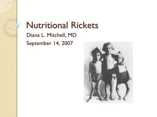 Nutritional Rickets