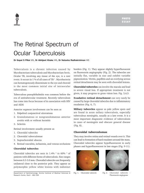 Choroidal Tubercles