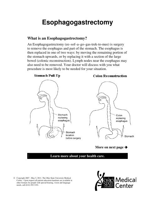Esophagogastrectomy - Patient Education Home