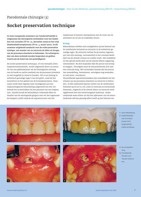 Socket preservation technique