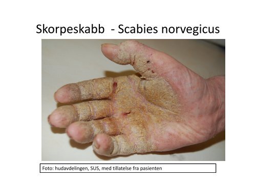 Skabb hos eldre : overkro