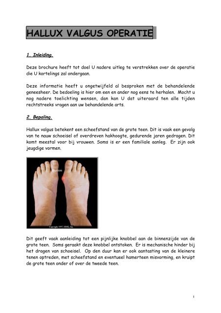 hallux valgus operatie - Orthopedie Stedelijk Ziekenhuis Roeselare