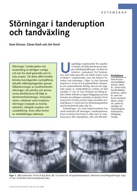 Störningar i tanderuption och tandväxling - Tandläkartidningen