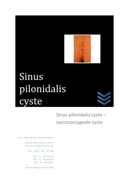 Sinus pilonidalis cyste - Jan Yperman Ziekenhuis