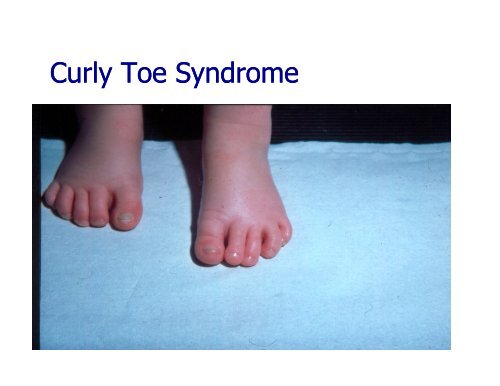 Curly Toe Syndrome