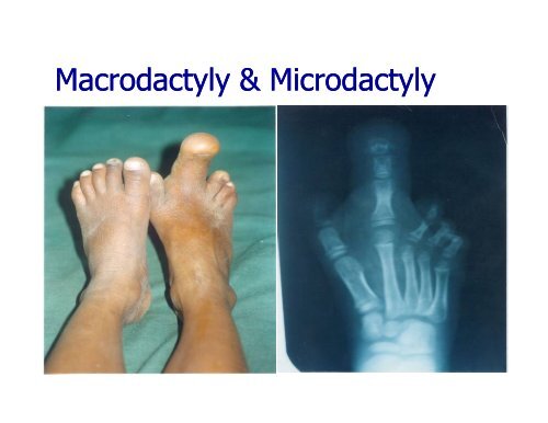 Macrodactyly & Microdacty