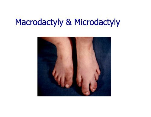 Macrodactyly & Microdacty