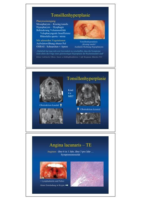 Tonsillenhyperplasie Phar