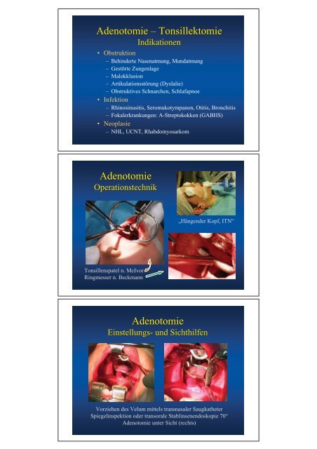 Tonsillolith in situ und