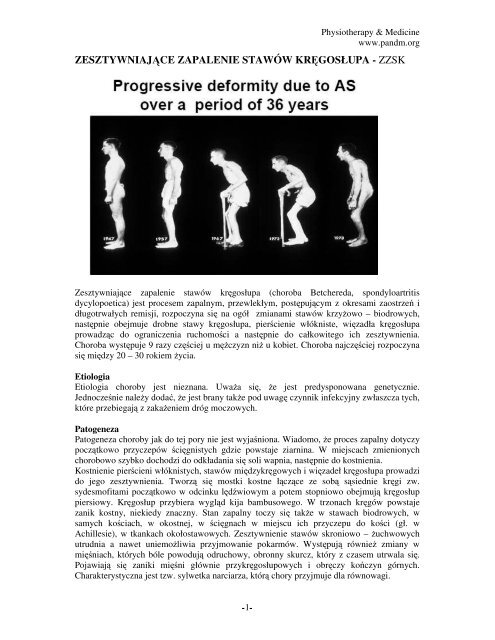 zesztywniające zapalenie stawów kręgosłupa - zzsk - Pandm