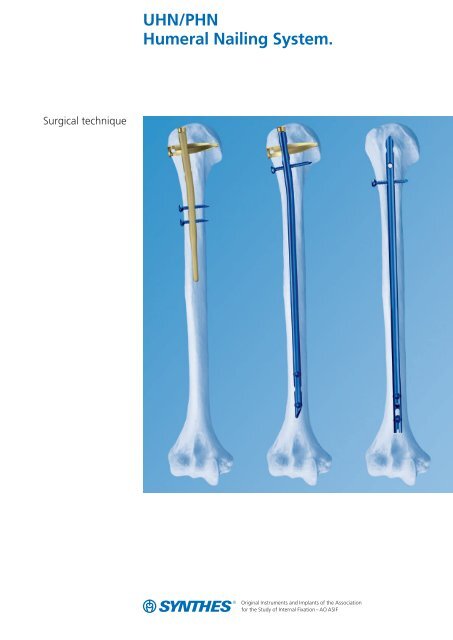 UHN/PHN Humeral Nailing System. - Osteosyntese