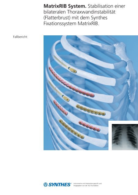 MatrixRIB System. Stabilisation einer bilateralen ... - Synthes