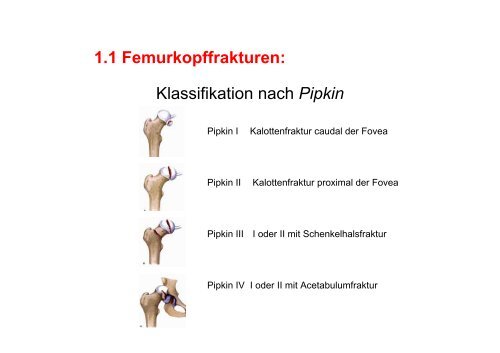 1.1 Femurkopffrakturen: K