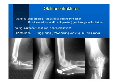 Olekranonfrakturen Anatom
