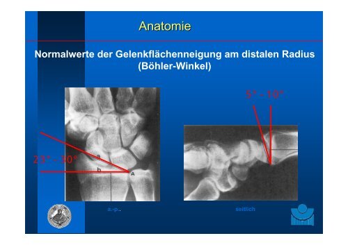 7. distale Radiusfrakture