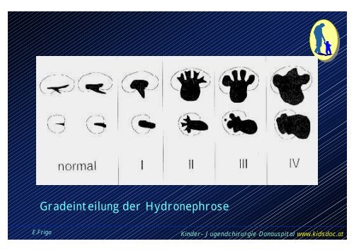 Gradeinteilung der Hydronephrose