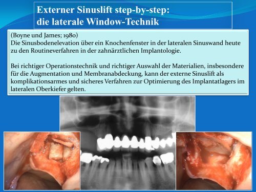 die laterale Window-Technik