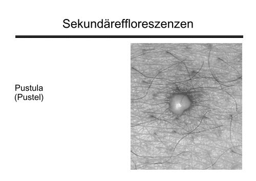 Pustula (Pustel) Sekundä