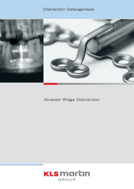 Alveolar Ridge Distraction Distraction Osteogenesis - Inmeda
