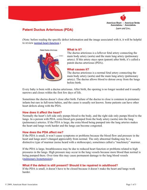 Patent Ductus Arteriosus (PDA) - American Heart Association